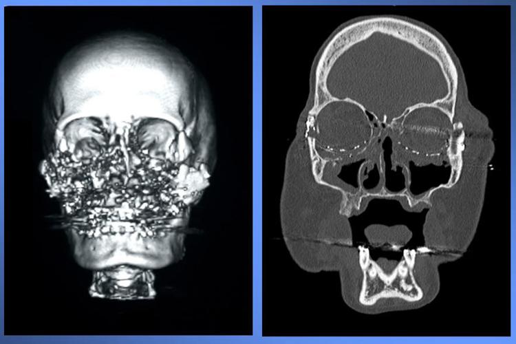 Une Américaine a reçu la première greffe de 80 % du visage