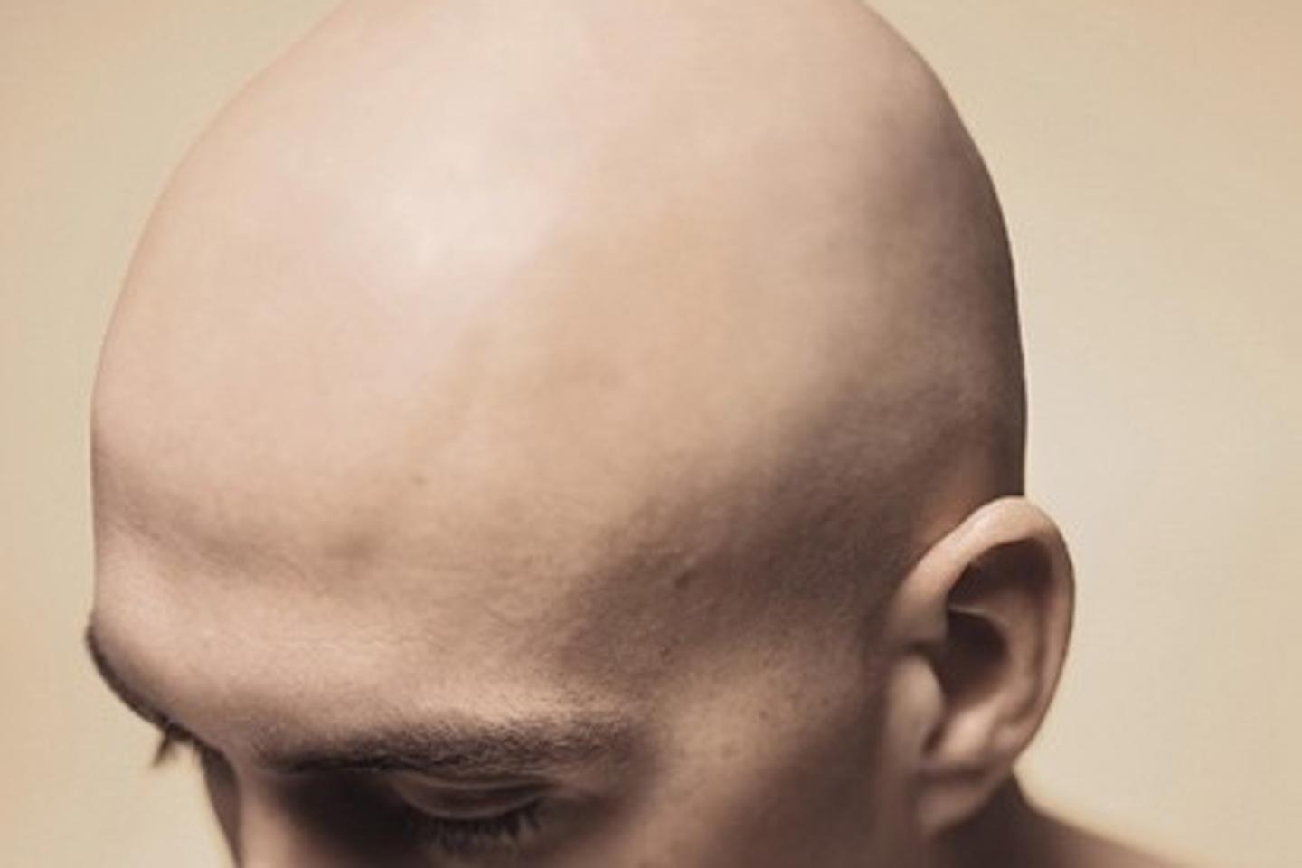 Espoir pour les chauves après la découverte d'une substance anti-stress