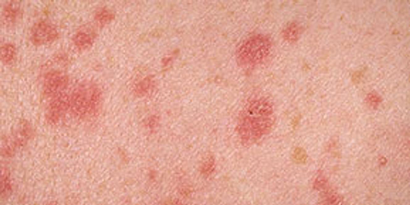 Le psoriasis, un combat de tous les jours