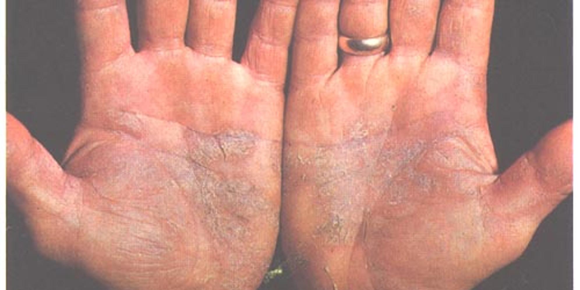 Le psoriasis, un combat de tous les jours