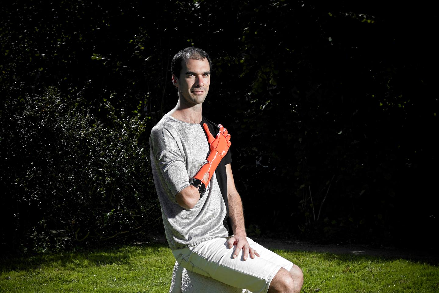 Amputé, Nicolas Huchet a fabriqué sa propre main bionique