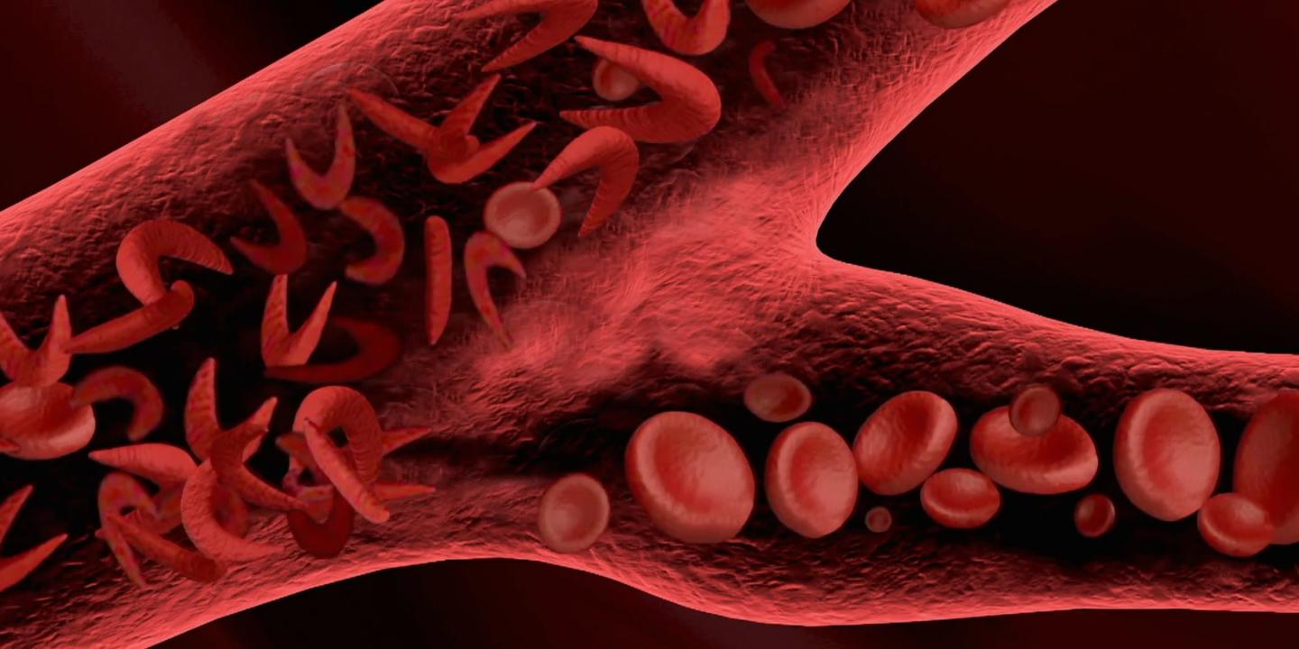 La drépanocytose, qu’est-ce que c’est