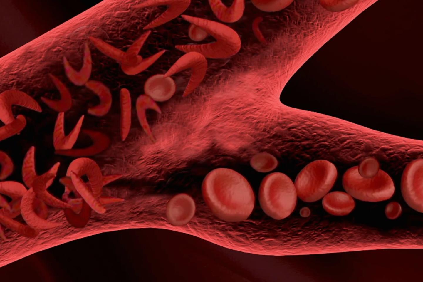 La drépanocytose, qu’est-ce que c’est