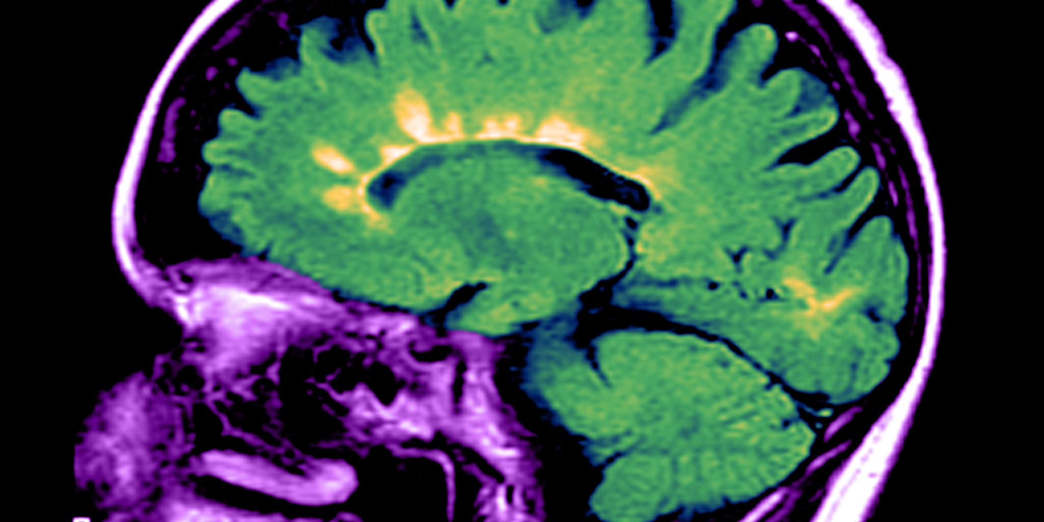 L’autogreffe de moelle, traitement négligé contre la sclérose en plaques