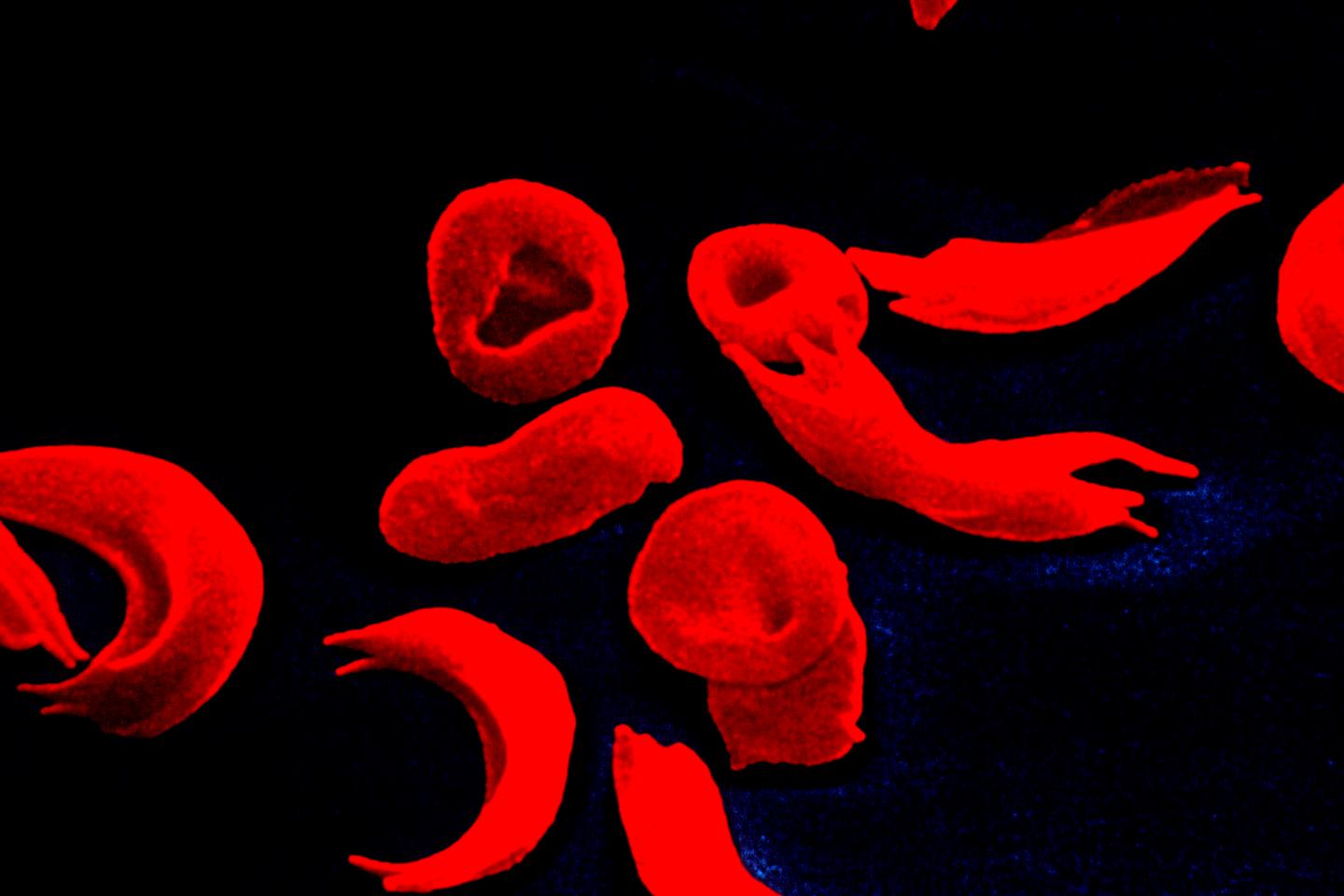 « La drépanocytose doit recevoir l’attention légitime qu’elle mérite