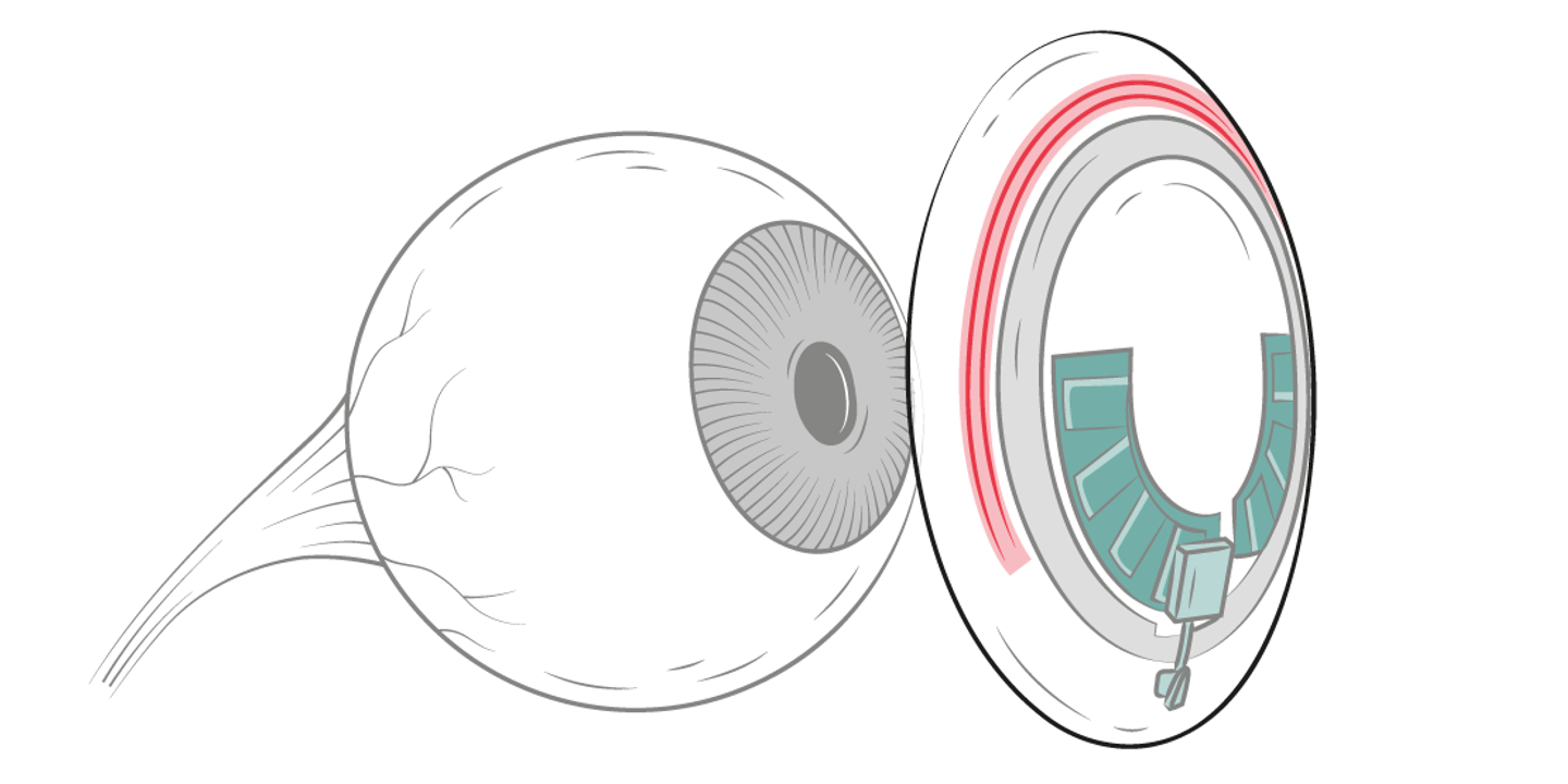 Mise au point d’une lentille intelligente pour diagnostiquer et soigner ...