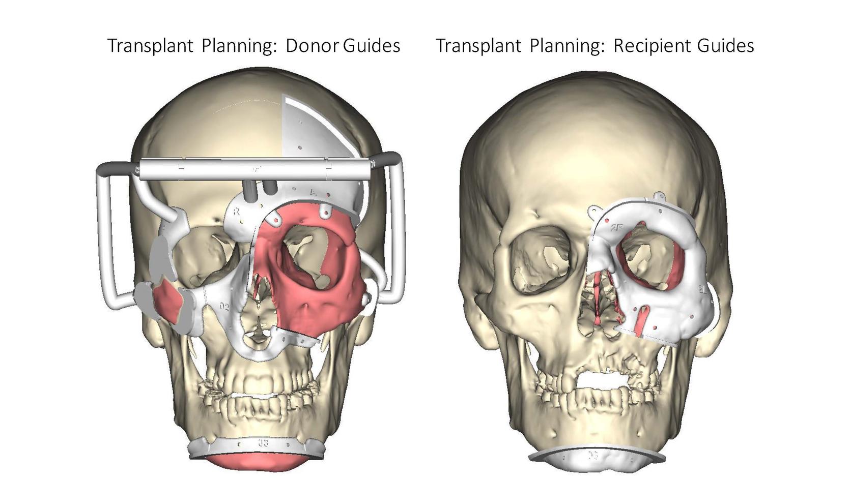 Un œil complet greffé pour la première fois