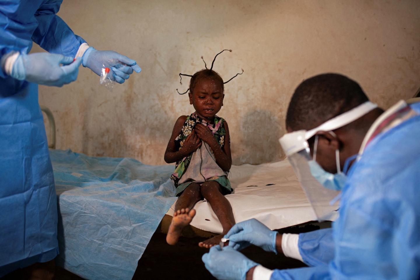 Monkeypox Test Center in Democratic Republic of Congo: Latest Updates ...
