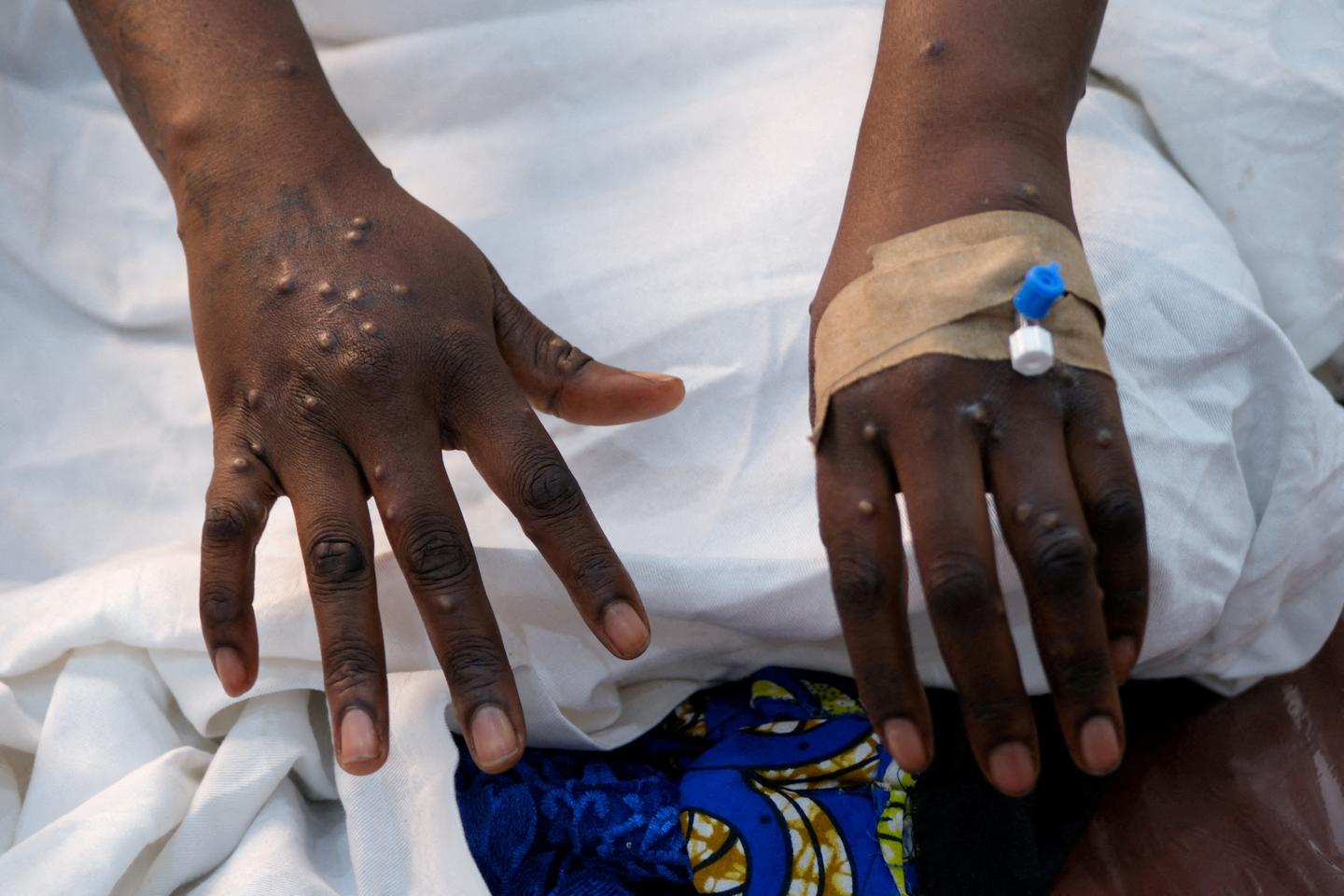 Mpox : premier cas du variant clade 1b au Royaume-Uni