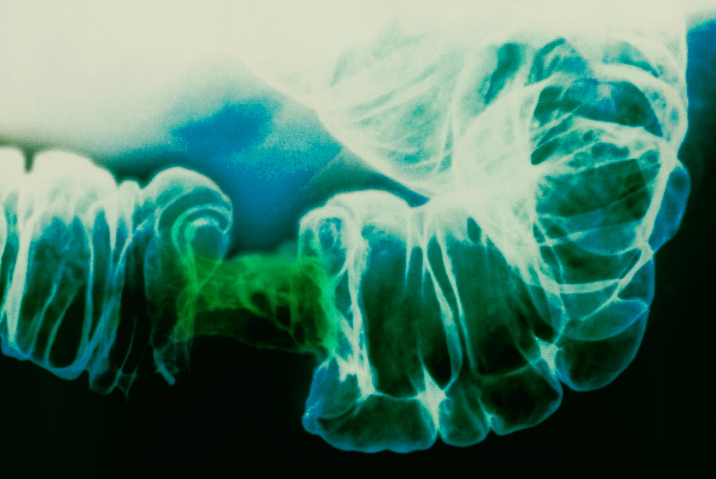 L’aspirine réduit de moitié le risque de récidive dans une forme ...